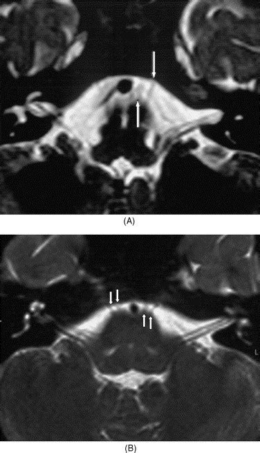 The Cisternal Segment Of The Abducens Nerve In Man Three Dimensional Mr Imaging European