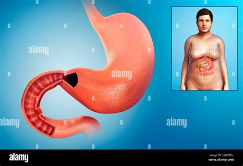 Illustration Of Female Stomach And Duodenum Stock Photo Alamy