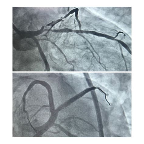 Pankaj Jariwala On Linkedin Another Case Of Tap Technique For Large Diagonal And Lad