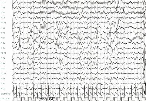 Focal Status Epilepticus In Nonketotic Hyperglycinemia Download