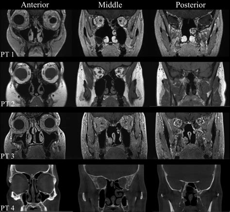 Coronal Mri Scans Of The Paranasal Sinuses In Endoscopic Endonasal