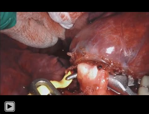 Overview Of The Outcomes Of Robotic Segmentectomy And Lobectomy Pmc