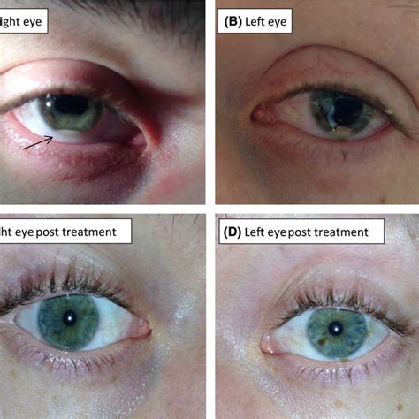 Patients Eyes With Bilateral Hypopyon A And B Upon Presentation And