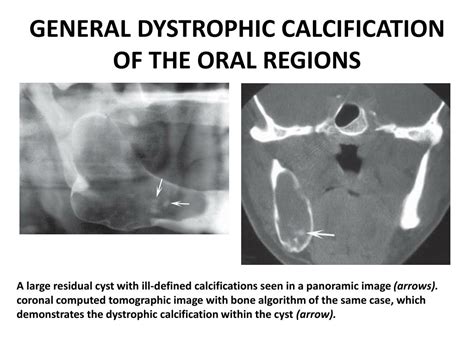 Ppt Soft Tissue Calcification And Ossification Powerpoint