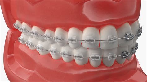 3d Model Ligature Braces On Teeth Model Turbosquid 2335696