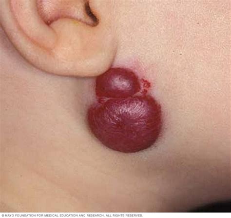 Hemangioma Síntomas Y Causas Mayo Clinic