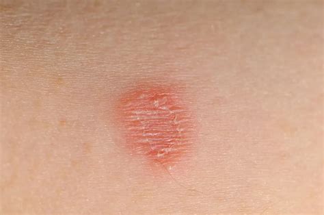 10 Rashes That Look Like Ringworm—but Arent