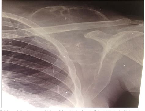 Figure 2 From A Case Report On Partial Scapulectomy With Glenoid Preservation For Chondromyxoid
