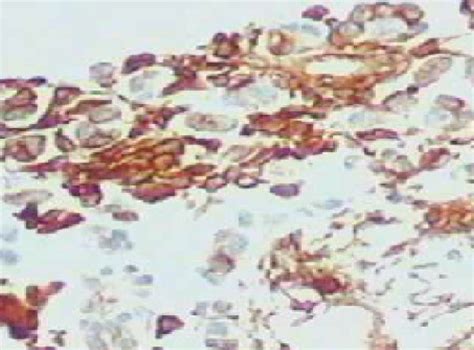 Expression Of Egfr And Pten In Epithelioid Mpem Tissue Egfr Was Based