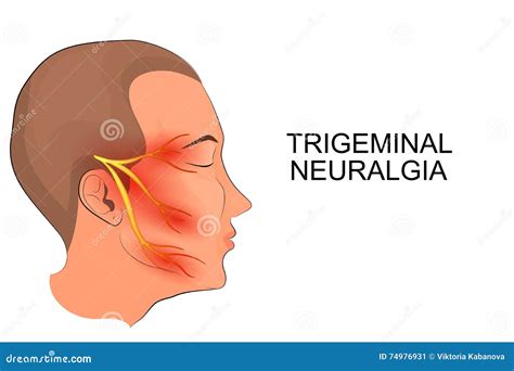 Trigeminal Neuralgia Neuroscience Cartoon Vector