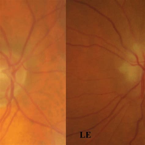 An Automatic Visual Field Test Showed Unspecified Visual Field Defects Download Scientific An Automatic Visual Field Test Showed Unspecified Visual Field Defects Download Scientific