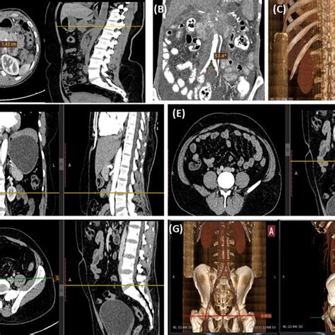 A Origin Of Celiac Trunk In Axial And Sagittal Scans B Angle Between