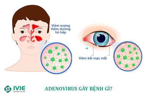 Adenovirus Là Gì Có Nguy Hiểm Không Xét Nghiệm Adenovirus