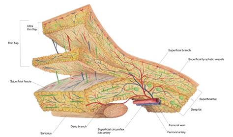Vascularized Lymph Vessel Transfer For Extremity Lymphedema Is