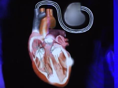 Pacemaker Like Device Restores Heart Function In Cancer Survivors