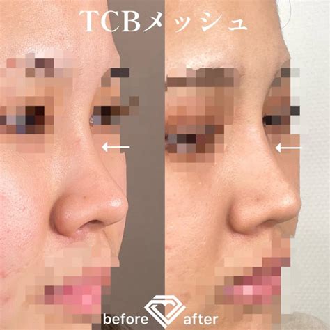 症例写真 ：tcbメッシュ 美容整形はtcb東京中央美容外科