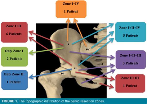 Mid Term Outcomes Of Hemipelvic Allograft Reconstruction After Pelvic