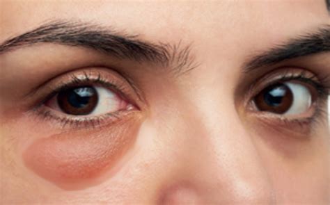 Poches Malaires Comment Les éliminer A Laide Traitement Naturel