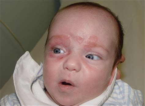 Cutaneous Neonatal Lupus Erythematosus Indian Journal Of Dermatology Venereology And Leprology