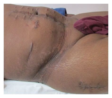 Healed Healthy Scars Of Postoperative Wounds At 6 Month Follow Up