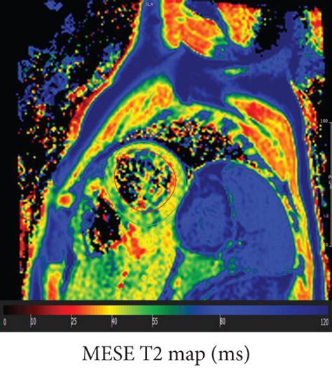 T1 And T2 Mappings Modified Look Locker Inversion Recovery Molli T1 Download Scientific