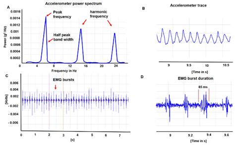 A Power Spectrum Analysis Of Accelerometer Recording From Patient 3 Download Scientific