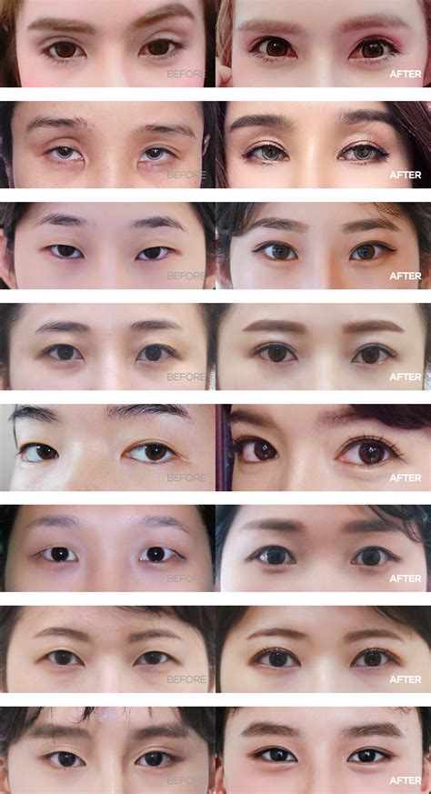 Epicanthoplasty Grand Plastic Surgery