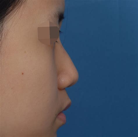 Nasal Bridge Augmentation Before And After Seoul Korea Hanabi