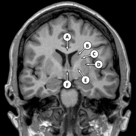 Sagittal Brain Basal Ganglia