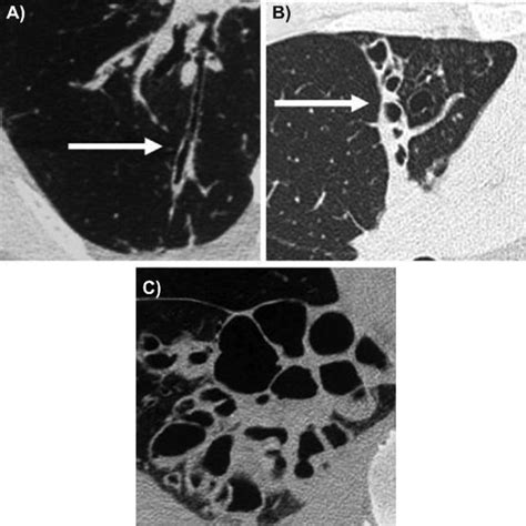 Pdf The Pathophysiology Of Bronchiectasis