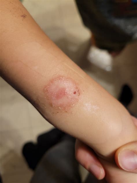 What Is Wild Parsnip How To Treat Wild Parsnip Rash Donvey Farms