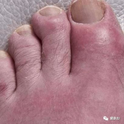 大脚趾疼痛，是痛风的首发症状，不以为意小心造成残疾尿酸关节饮食