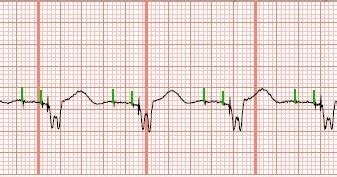 Ekg Rhythm Strips 48