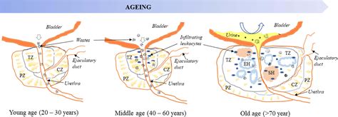 Figure 1 From The Etiology And Pathogenesis Of Benign Prostatic Hyperplasia The Roles Of Sex