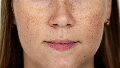 Hyperpigmentation Causes Symptoms Treatment Types And More A