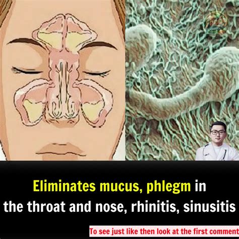 4 Effective Home Remedies To Eliminate Mucus And Phlegm In The Throat Sinusitis And Rhinitis