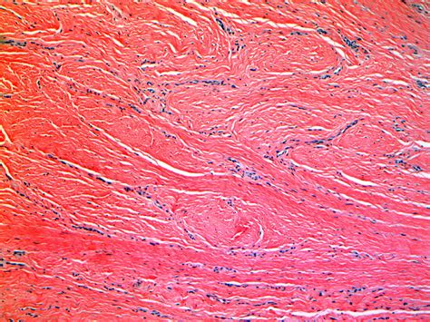 Keloid Pathology2 Keloid Removal Expert New York