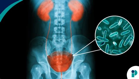 Detectan Rara Infección Urinaria Por Rodentibacter Pneumotropica En