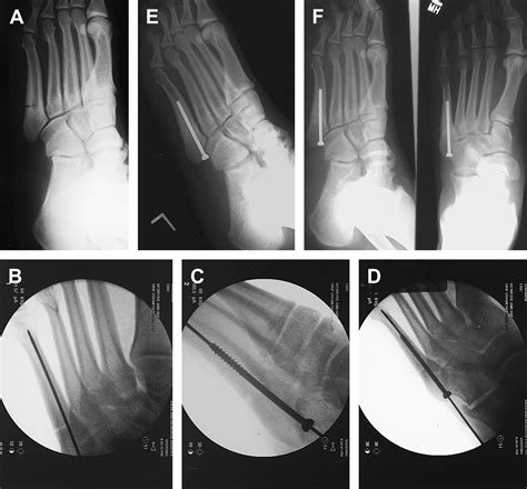 The Complicated Jones Fracture Including Revision And Malalignment
