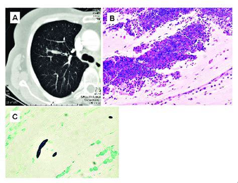 Abpa As A Tree In Bud Opacity With Bronchiectasis Due To Mucoid