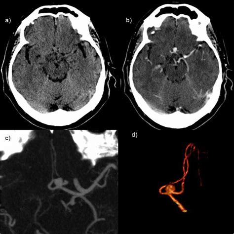 Brain Ct Of Anterior Communicating Artery Aneurysm Axial Unenhanced