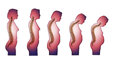Osteoporosis Causes Treatment Hormonal Influence