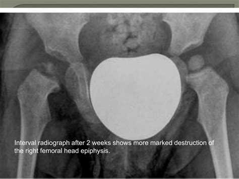 Pediatric Hip Radiology Pptx