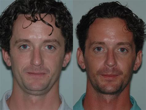 Corrective Jaw Surgery Before After Gallery