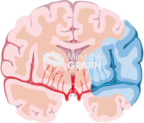 Brain Ischemic Stroke