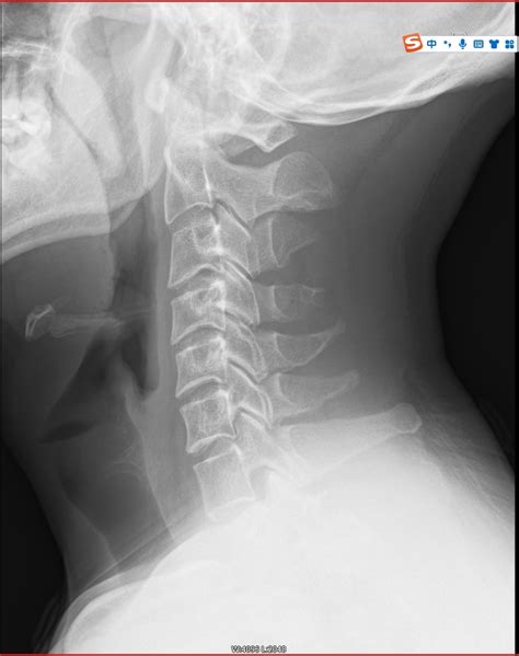 How To Use The Cervical Vertebrae Object Detection Api