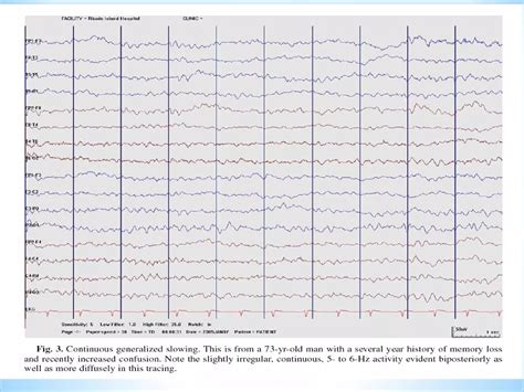 Encephalopathy With Eeg Based Grading Ppt