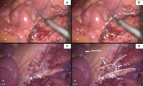 The Value Of Icg Guided Left Colon Vascular Variation And Anatomical Rules For The Radical