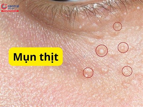Mách Bạn Cách Chữa Mụn Thịt Tận Gốc Lấy Mụn Thịt ở Mắt Không để Lại Sẹo