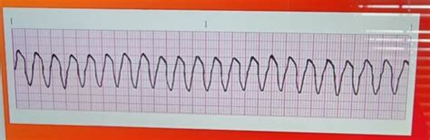 ACLS Flashcards Quizlet